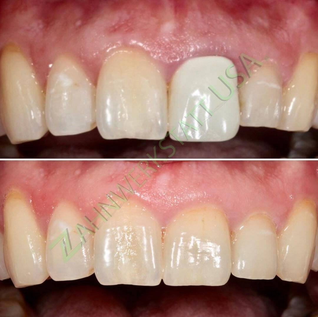 SINGLE RESTORATION | Zahnwerkstatt USA